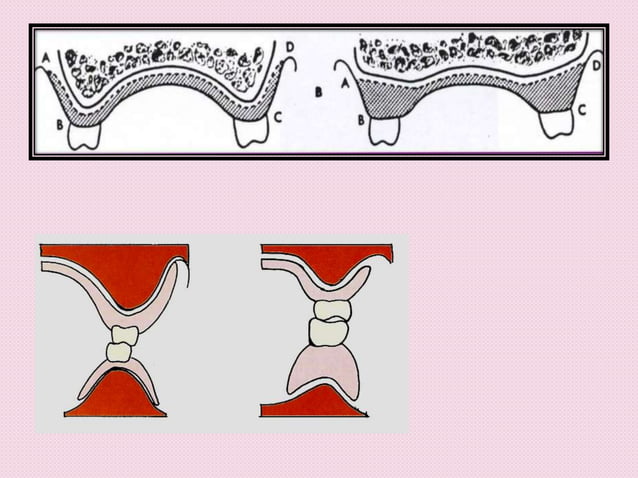 Stability in complete dentures