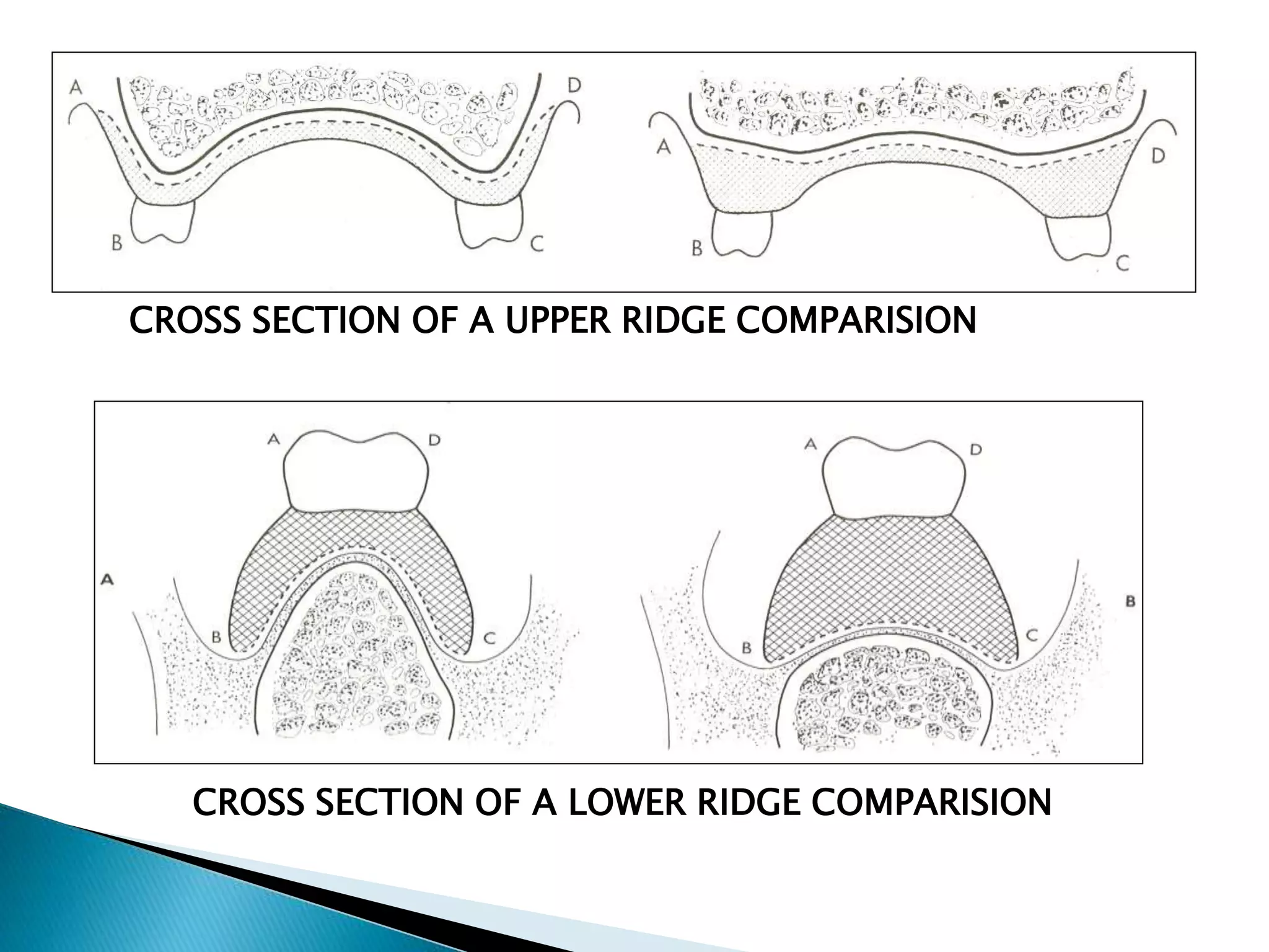 Stability in complete dentures | PPTX