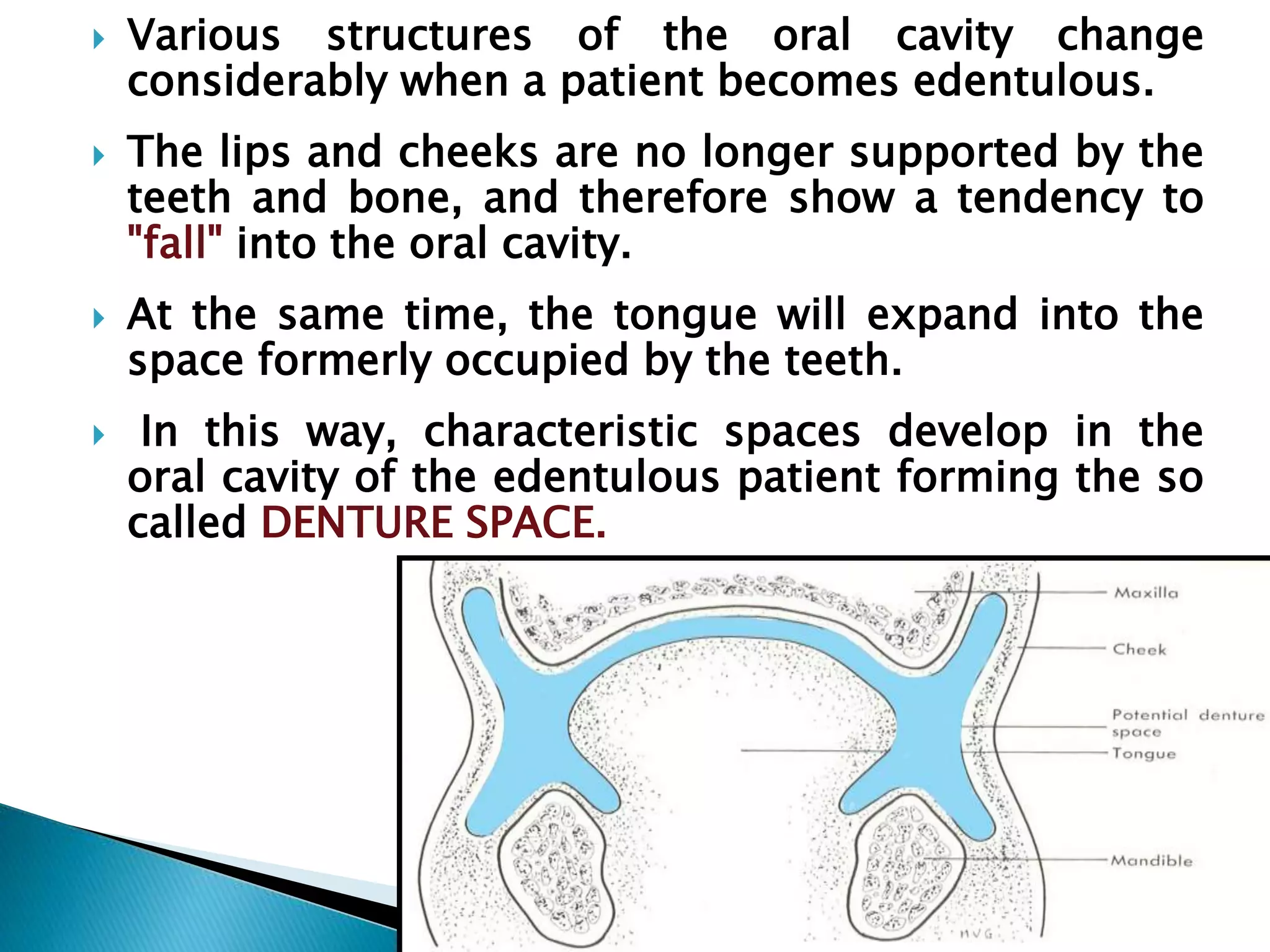 Stability in complete dentures | PPTX