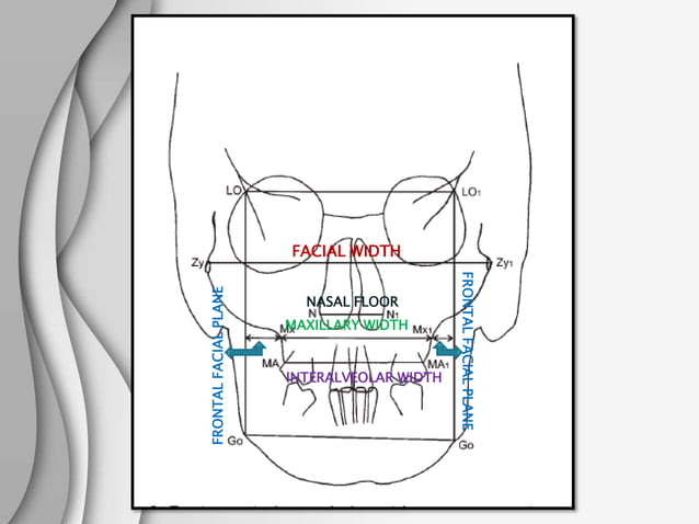 Stability of Orthopedic and Surgically Assisted Rapid Palatal Expansion ...