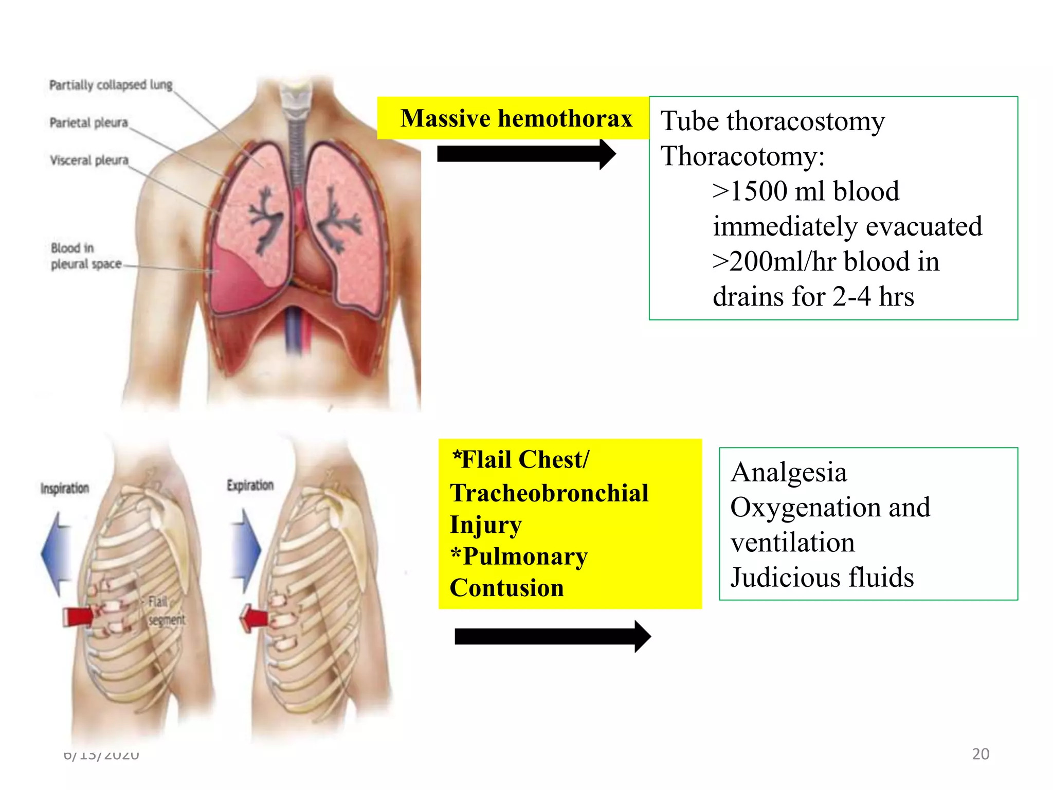 Stabilization of polytrauma patient | PPTX