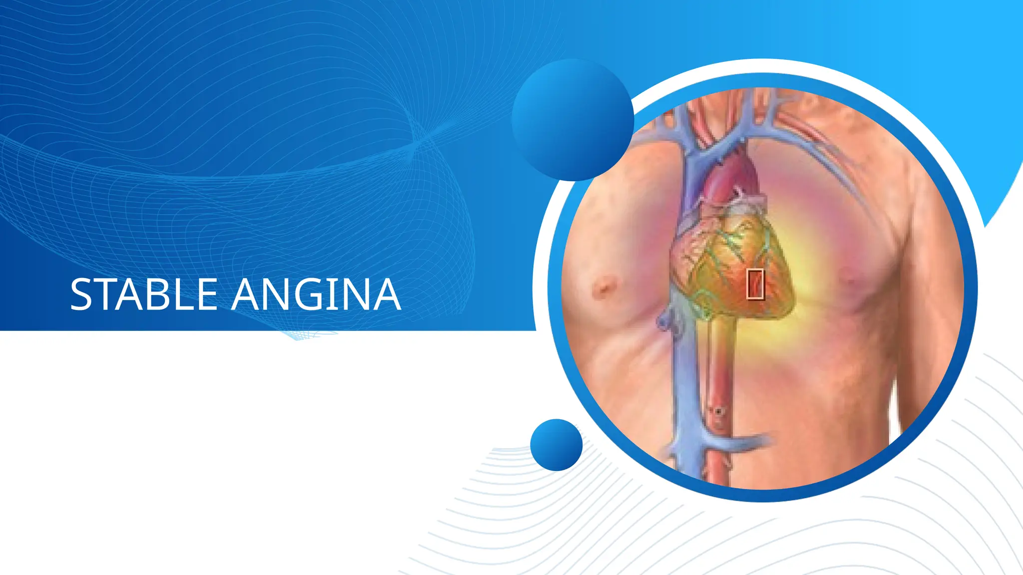 Overview of Stable Angina and Treatment (2).pptx