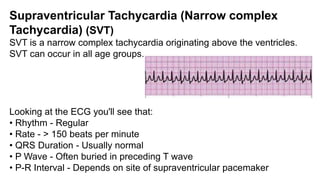 Stable & Unstabe Tachycardia.pptx