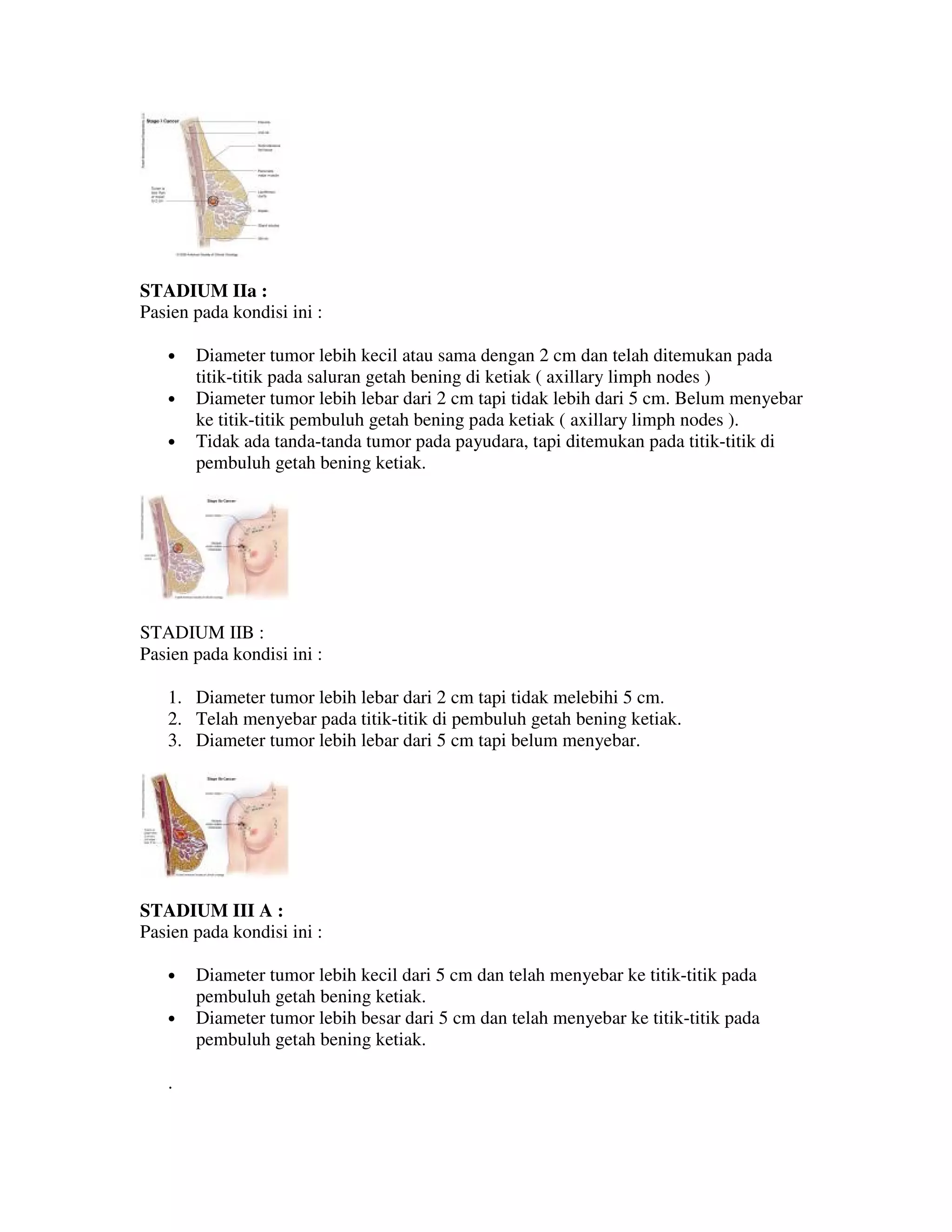 Stadium Kanker Payudara | PDF