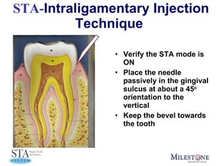 Sta Features Training Intralig.Inject. Erc | PPT