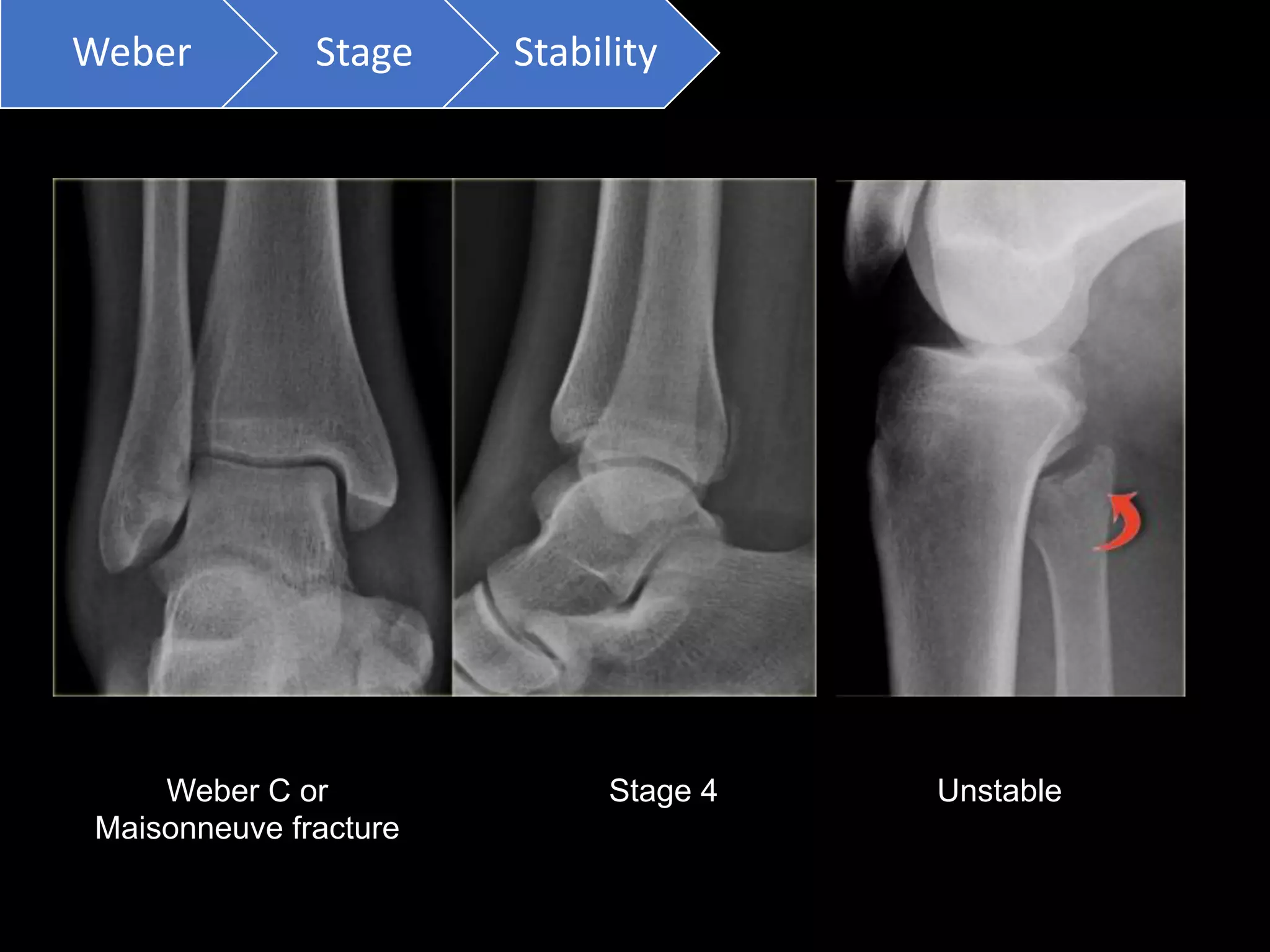 Xquang chấn thương khớp cổ chân - Ankle injury | PDF