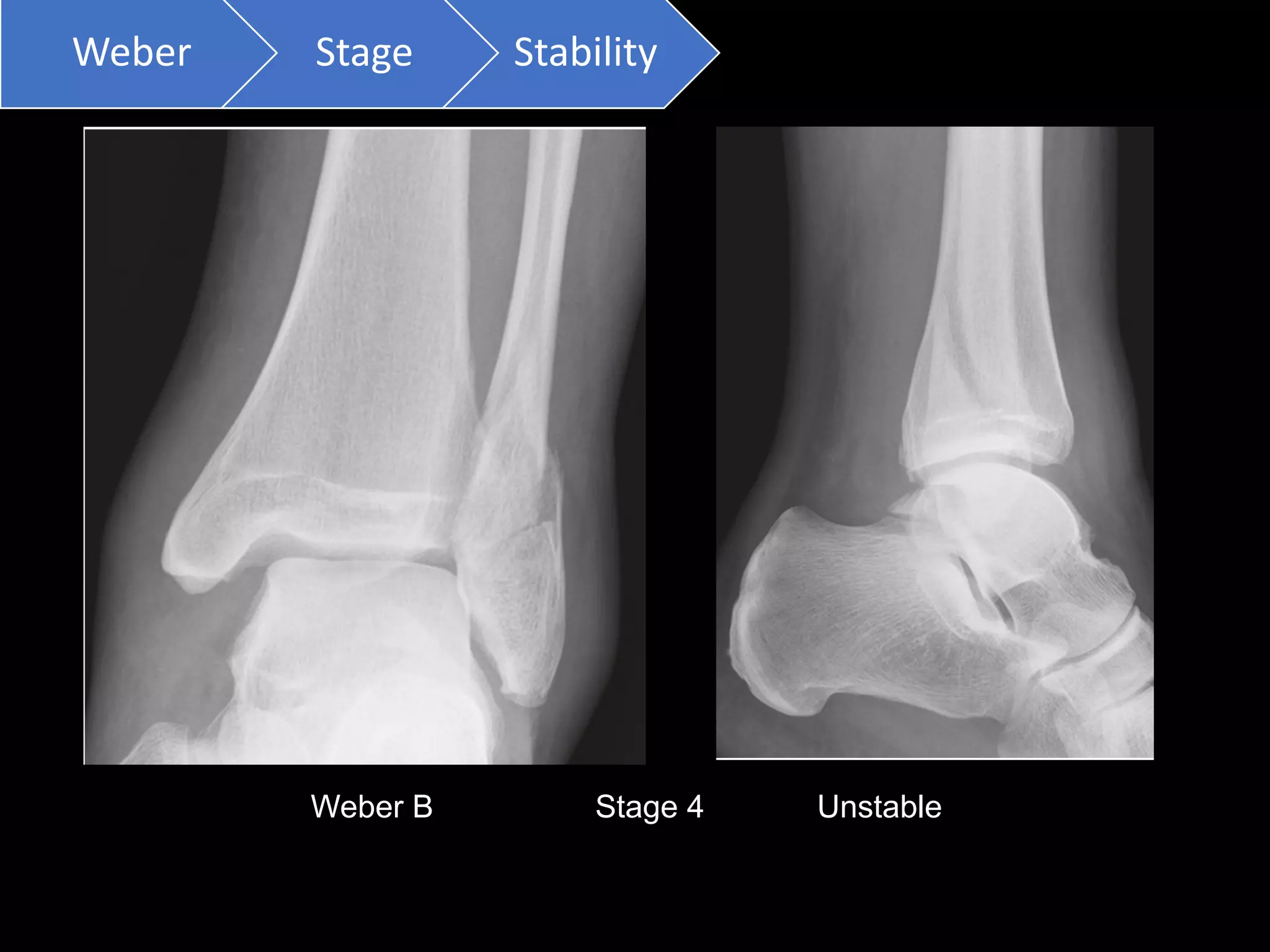 Xquang chấn thương khớp cổ chân - Ankle injury | PDF