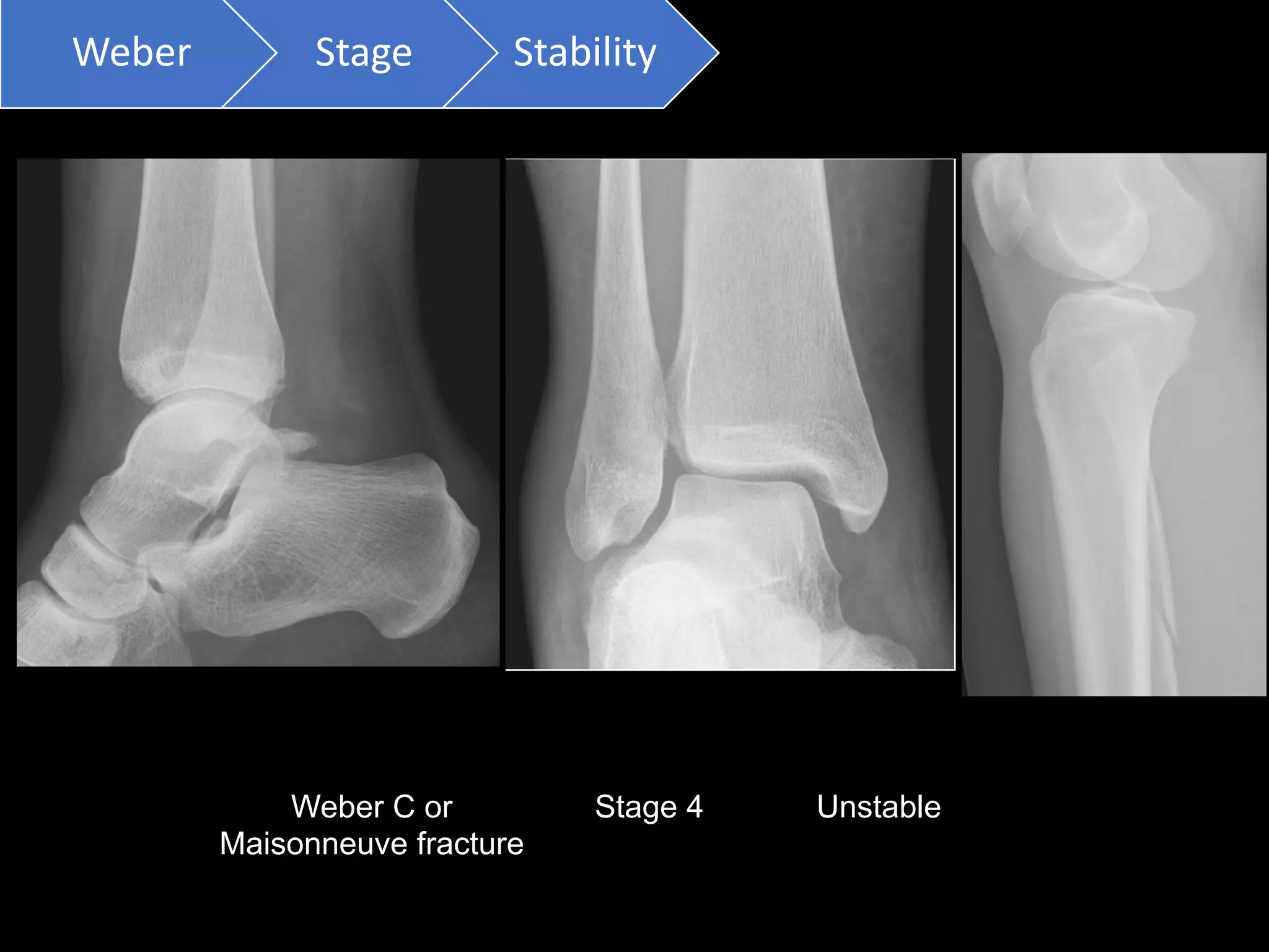 Xquang chấn thương khớp cổ chân - Ankle injury | PDF