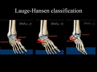 Xquang chấn thương khớp cổ chân - Ankle injury | PDF
