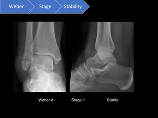Xquang chấn thương khớp cổ chân - Ankle injury | PDF