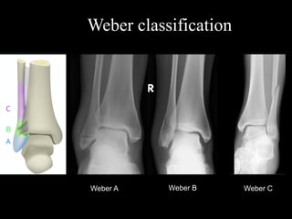 Xquang chấn thương khớp cổ chân - Ankle injury | PDF