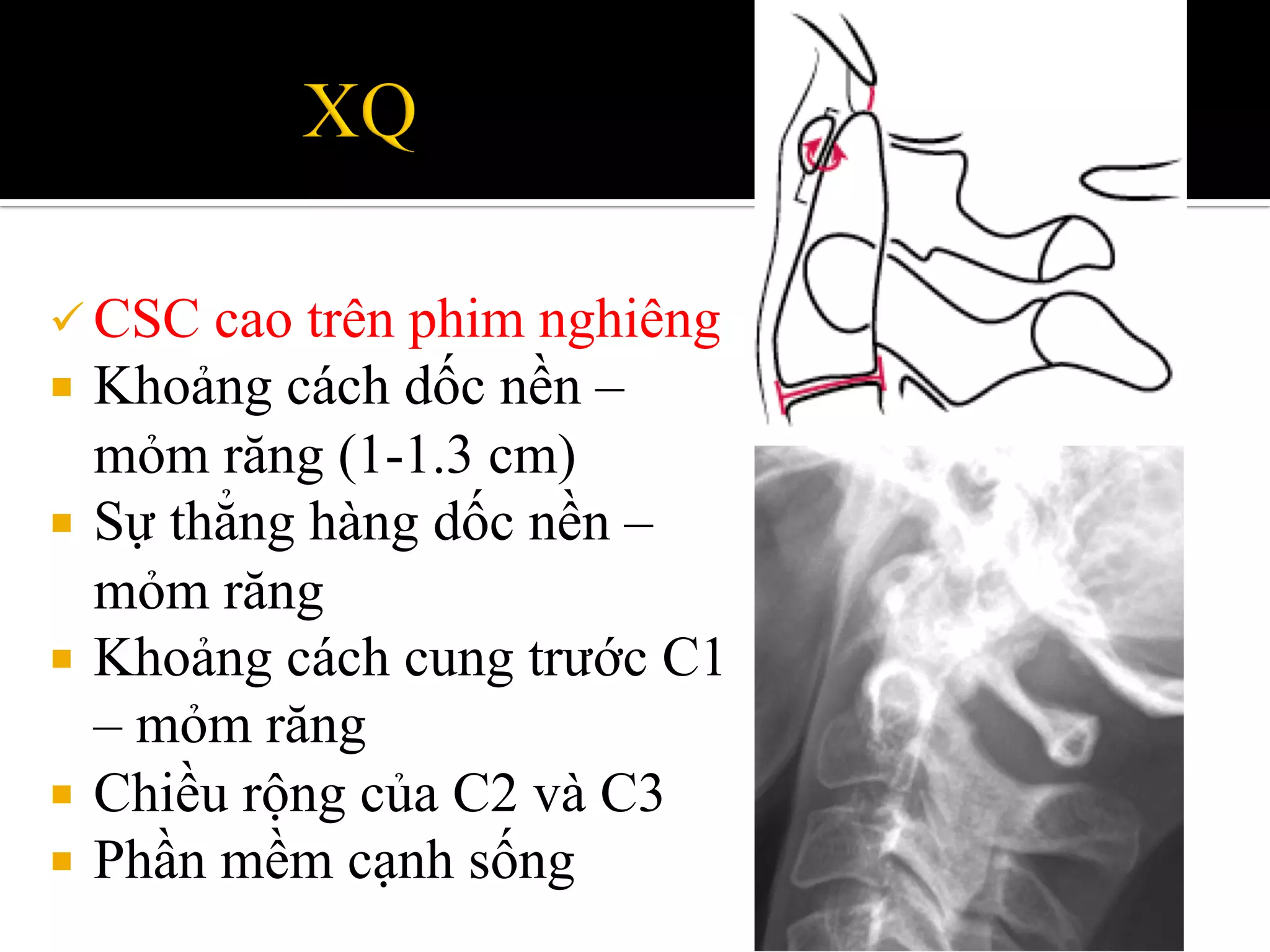 Chấn thương cột sống cổ - cervical spine injury | PDF