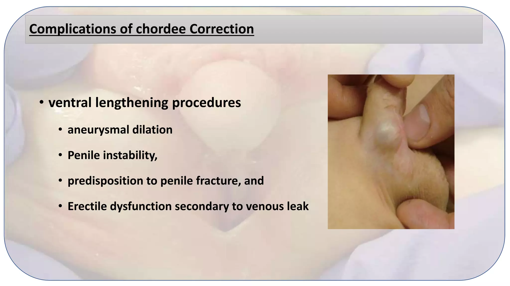 Staged urethroplasty decision making | PPT