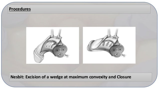 Staged urethroplasty decision making
