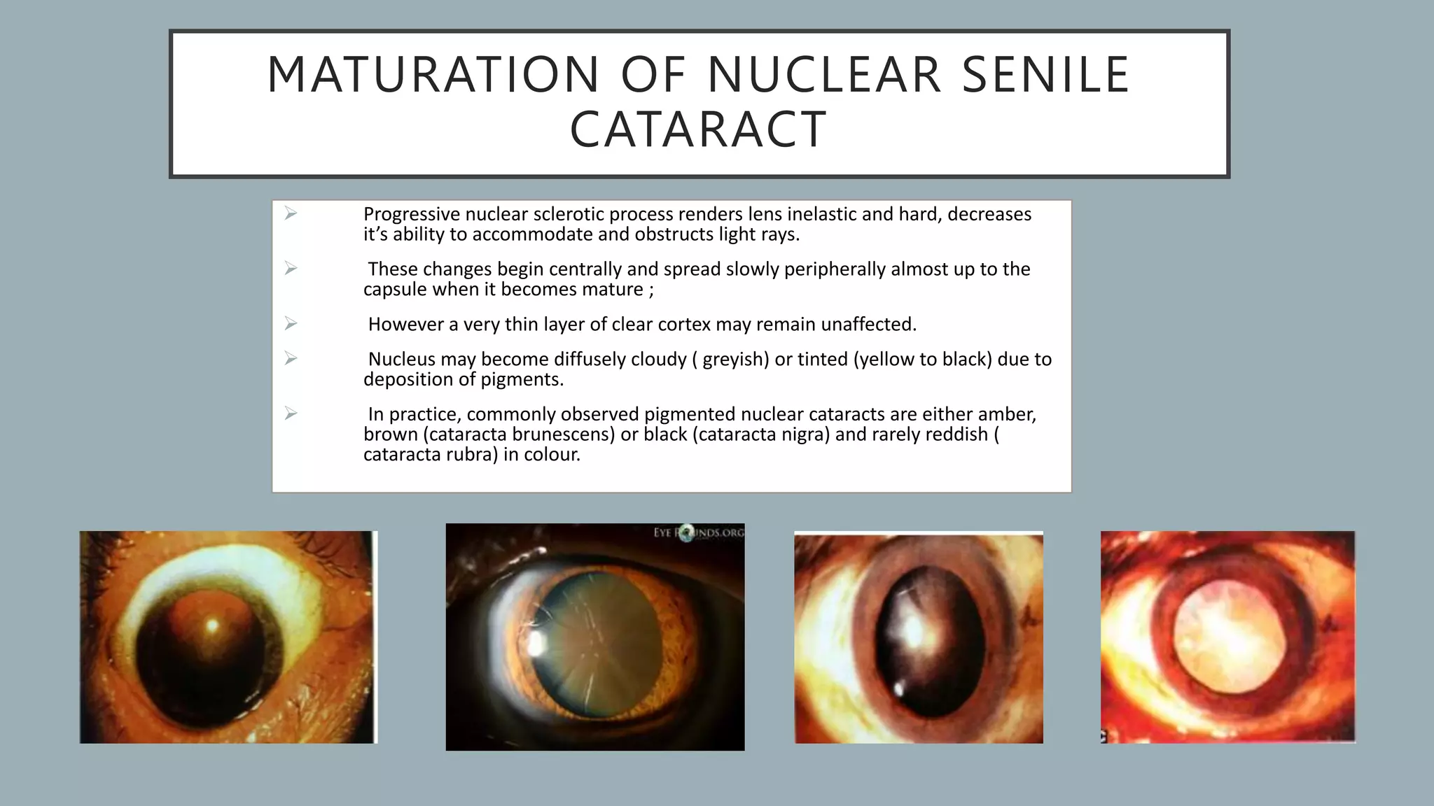 Stages and clinical features of cataract.pptx