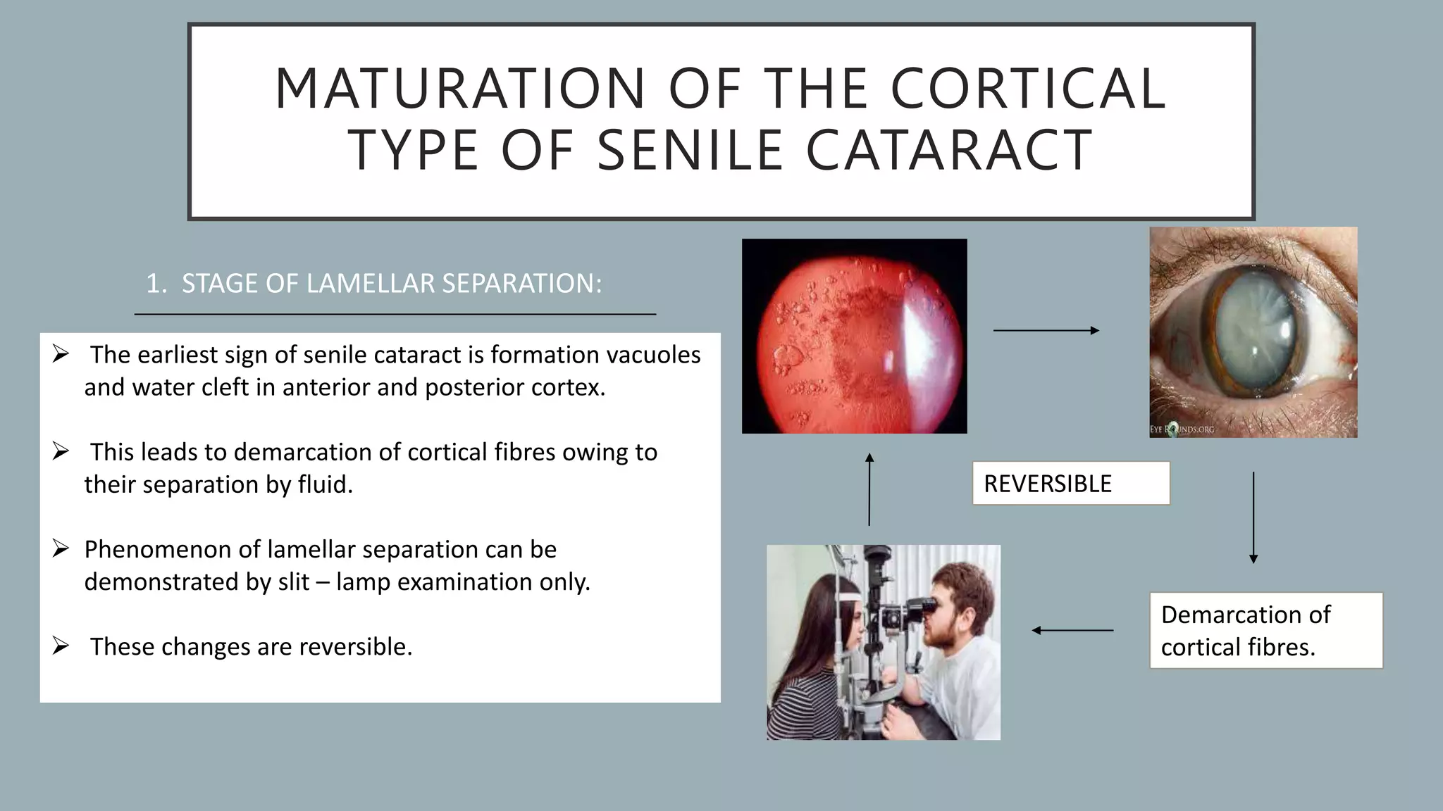 Stages and clinical features of cataract.pptx