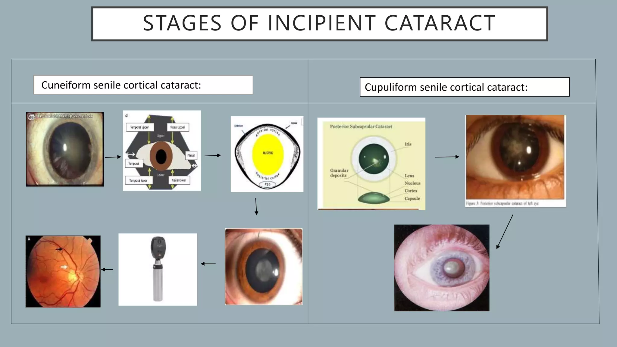 Stages and clinical features of cataract.pptx