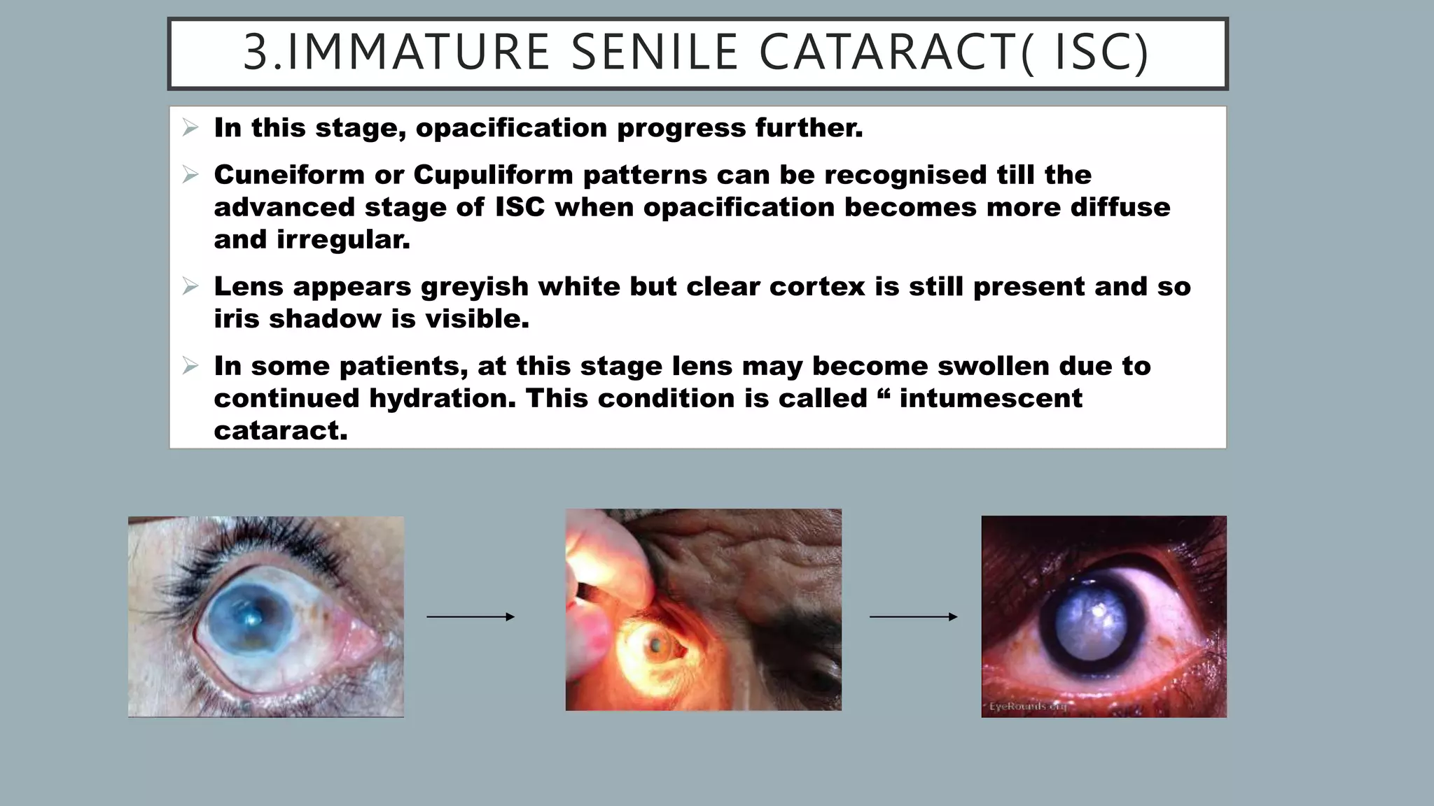 Stages and clinical features of cataract.pptx