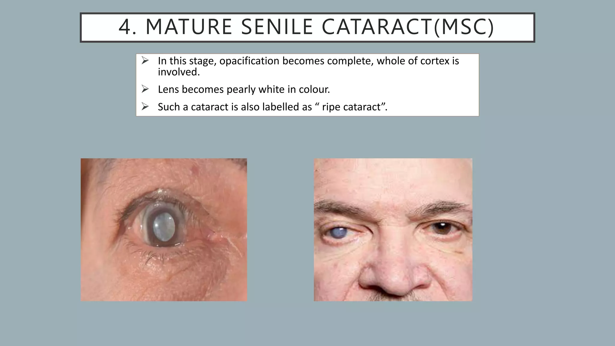 Stages and clinical features of cataract.pptx