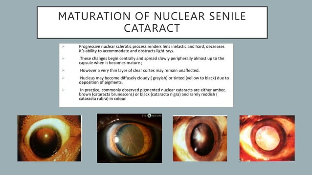 Stages and clinical features of cataract.pptx | Eye and Vision ...