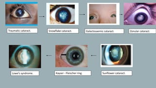 Stages and clinical features of cataract.pptx