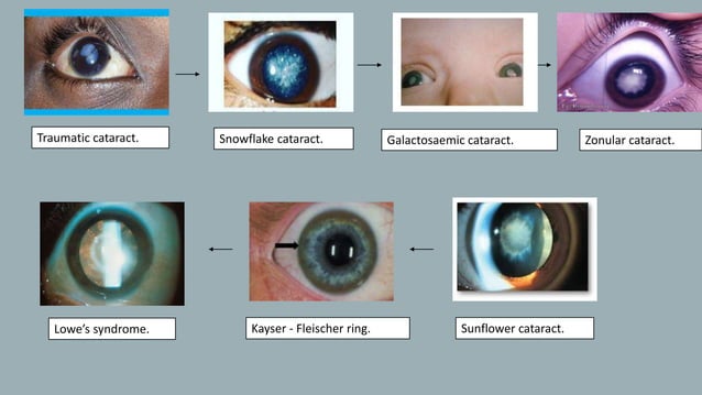 Stages and clinical features of cataract.pptx | Eye and Vision ...