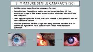 Stages and clinical features of cataract.pptx