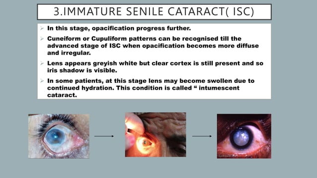 Stages and clinical features of cataract.pptx | Eye and Vision ...