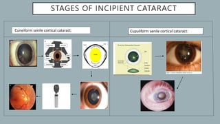 Stages and clinical features of cataract.pptx
