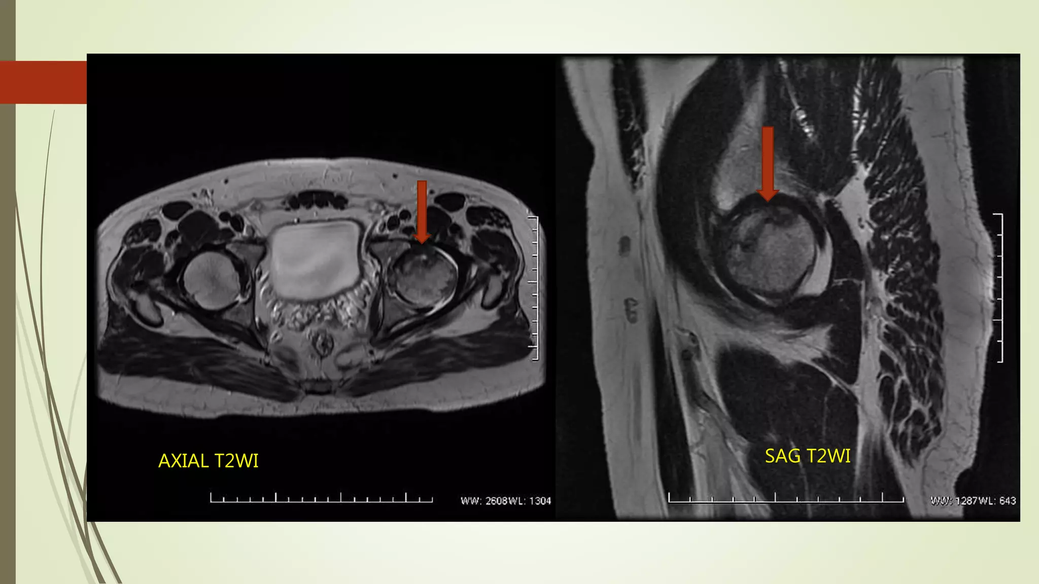STAGES OF AVN | PPTX