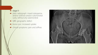 STAGES OF AVN | PPTX