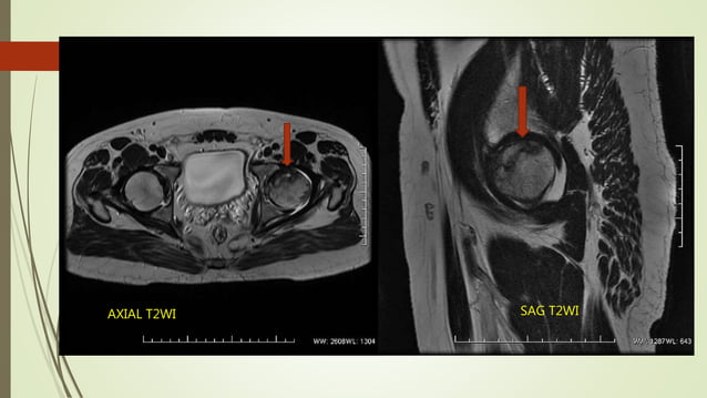 STAGES OF AVN | PPTX