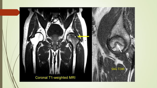 STAGES OF AVN | PPTX