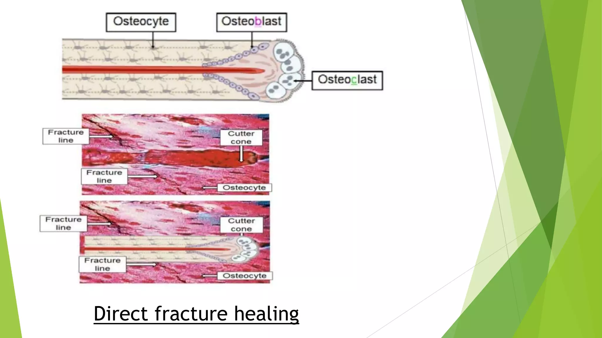 Stages of bone healing and various factors | PPTX