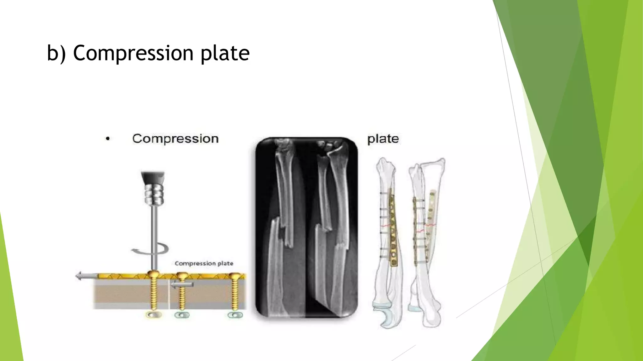 Stages of bone healing and various factors | PPTX