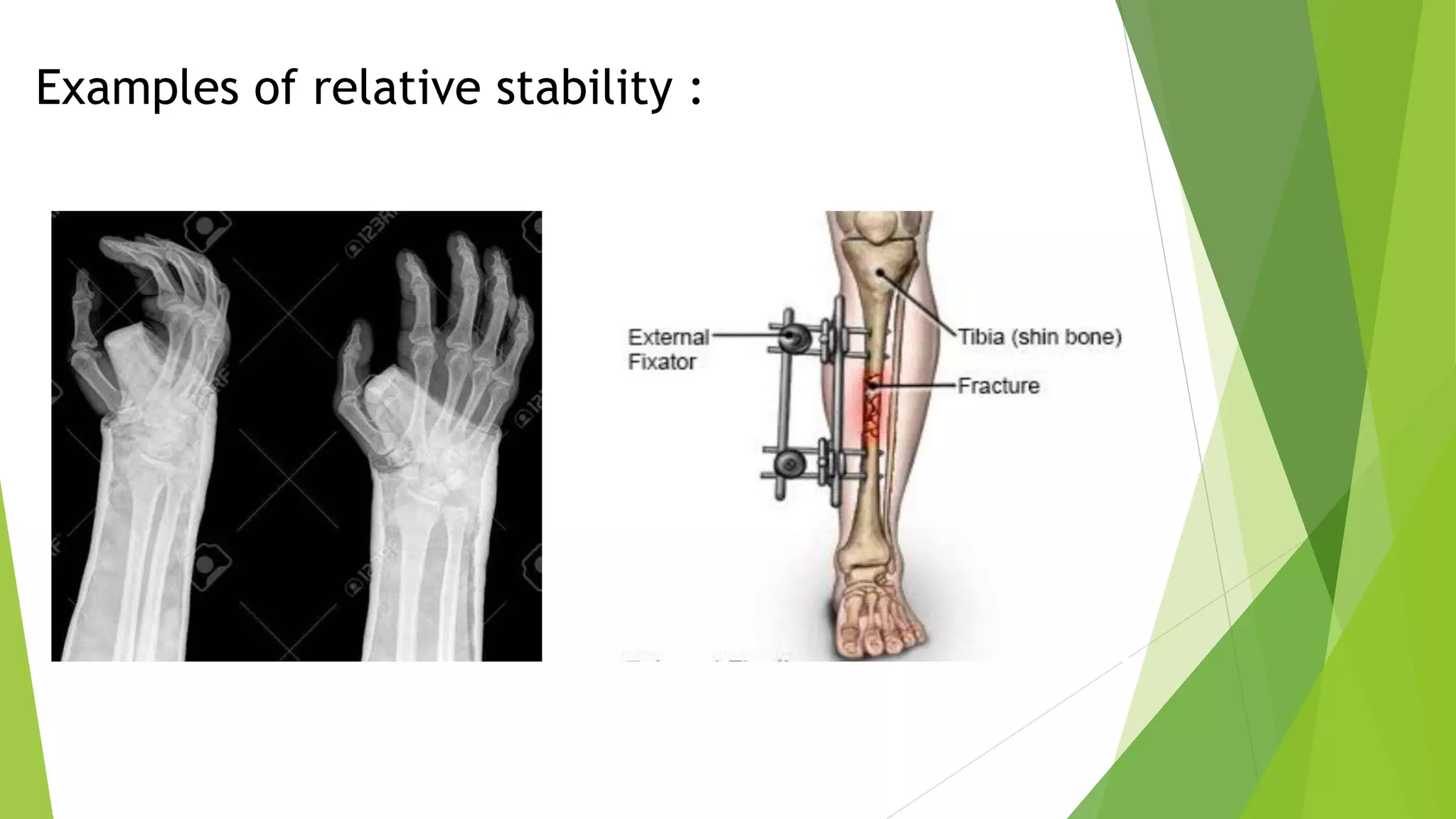 Stages of bone healing and various factors | PPTX