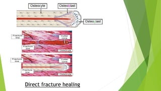 Stages of bone healing and various factors | PPTX