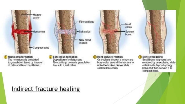 Stages of bone healing and various factors | PPTX