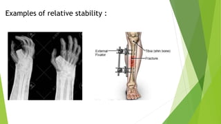 Stages of bone healing and various factors | PPTX