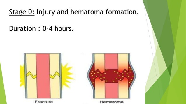 Stages of bone healing and various factors | PPTX