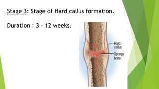 Stages of bone healing and various factors | PPTX