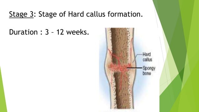 Stages of bone healing and various factors | PPTX