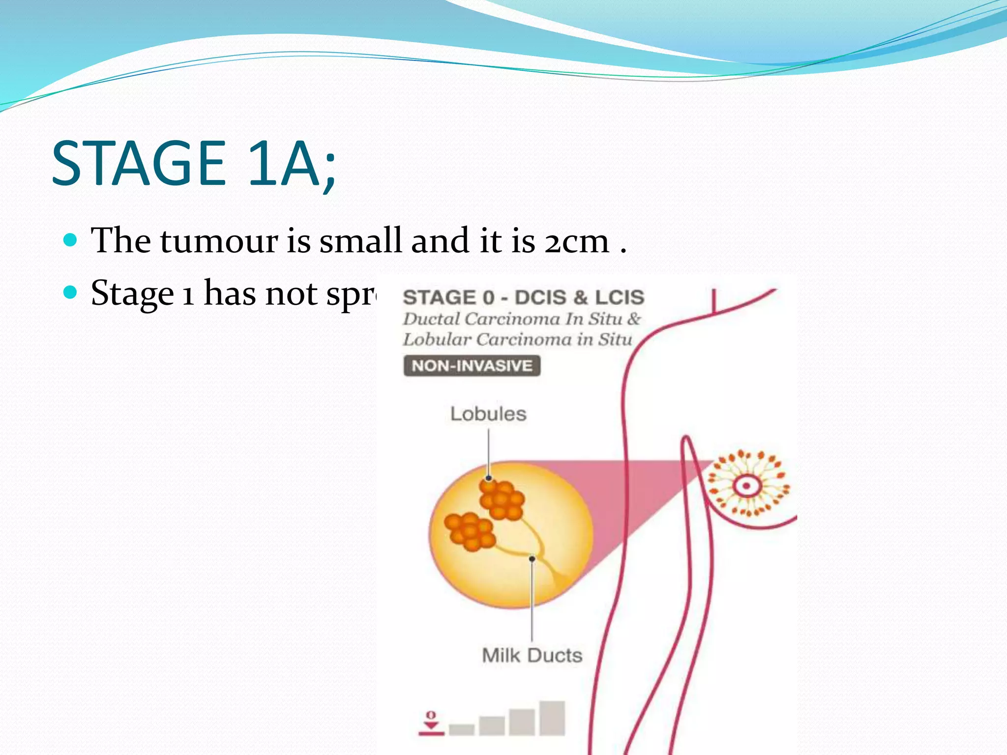 Stages of breast cancer | PPTX