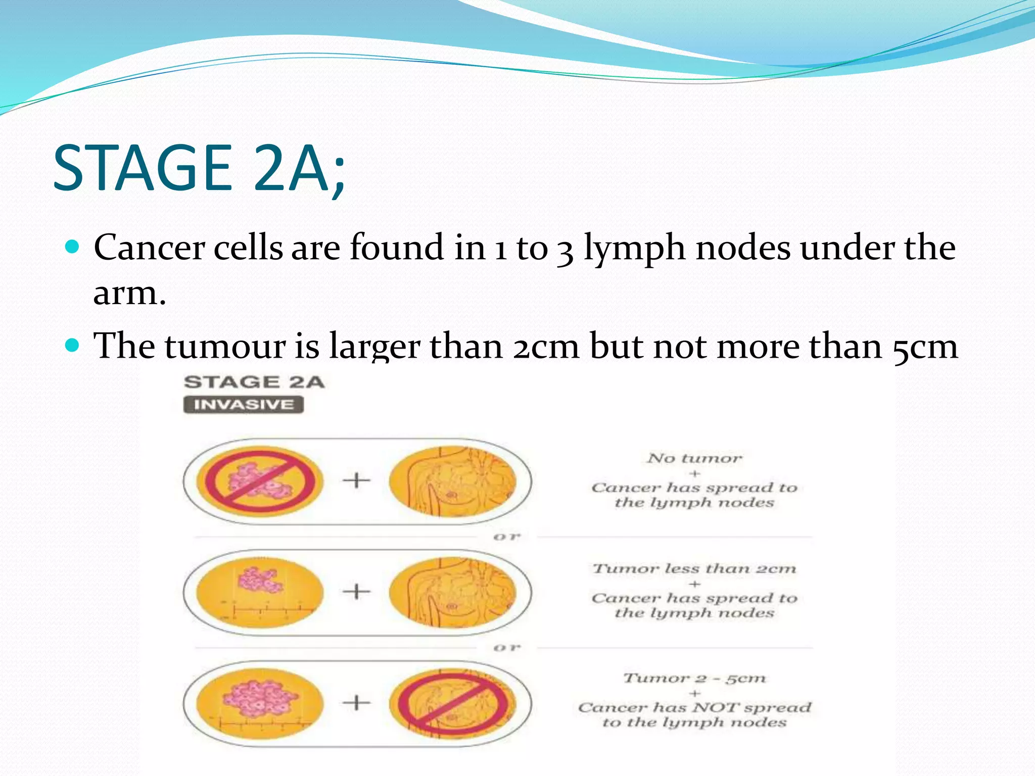 Stages of breast cancer | PPTX