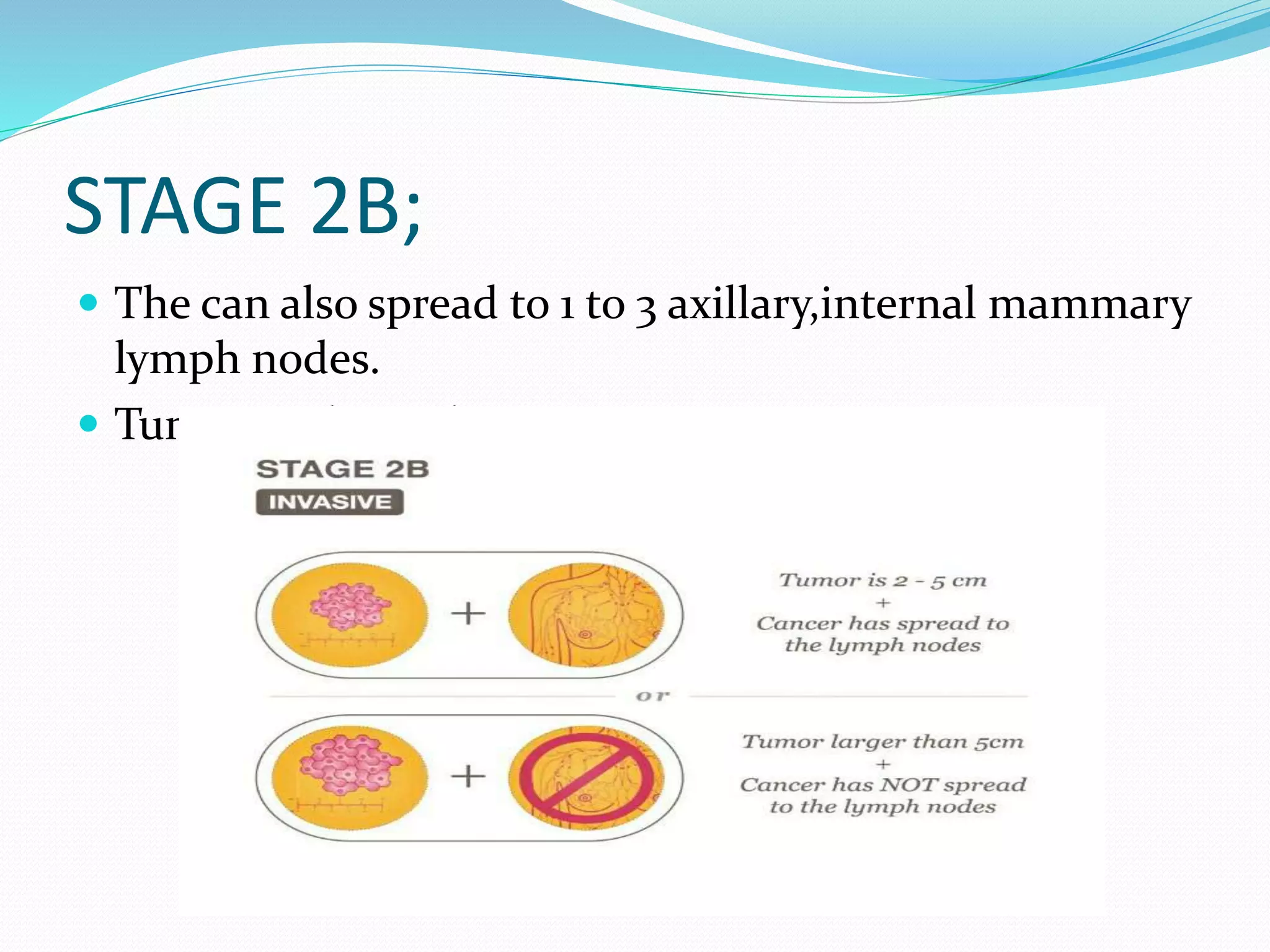 Stages of breast cancer | PPTX