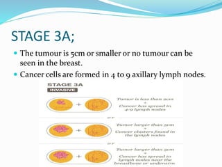 Stages of breast cancer | PPTX