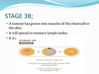 Stages of breast cancer | PPTX