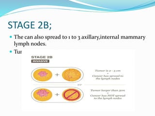 Stages of breast cancer | PPTX