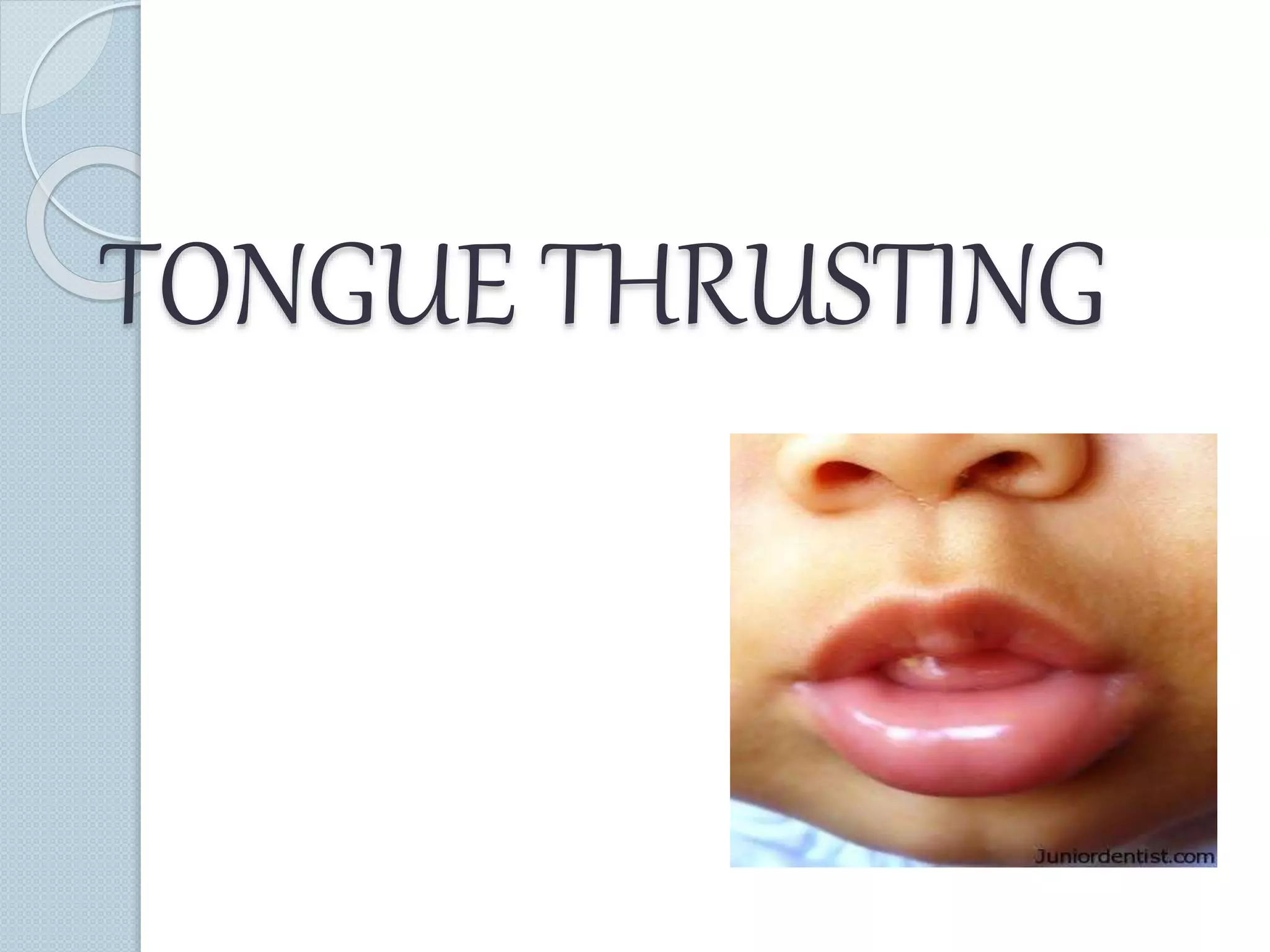Stages of deglutition and tongue thrusting | PPTX