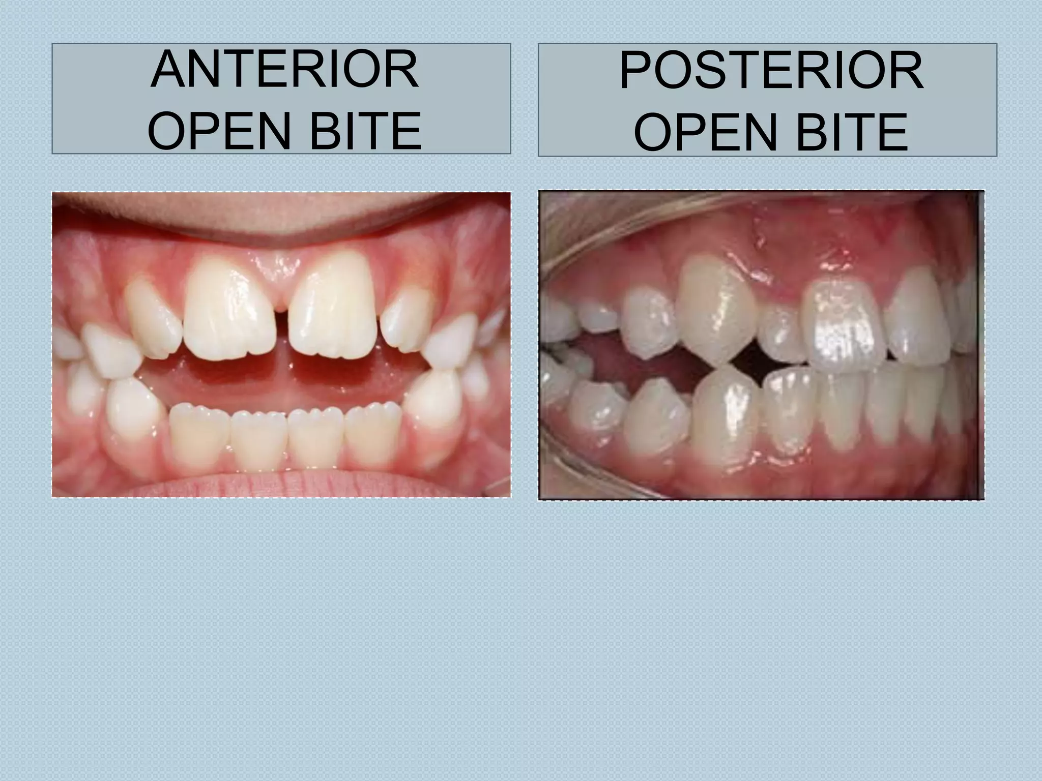Stages of deglutition and tongue thrusting | PPTX